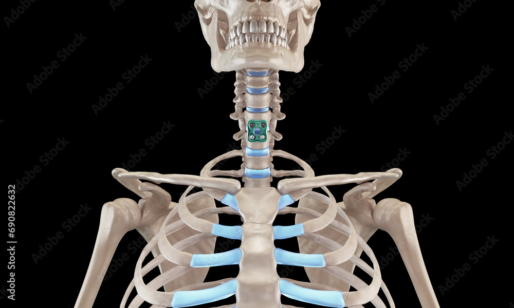 Orthopedic Spine Fixation Spinal Fixator Anterior Cervical Plate Stock ...