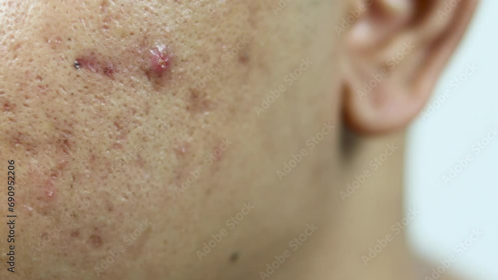 skin problems. Close up of Inflamed acne problem on Asian man face ...