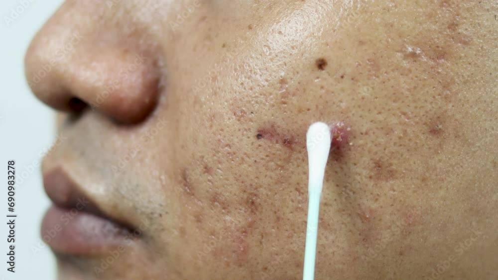 skin problems. Close up of Inflamed acne problem on Asian man face ...