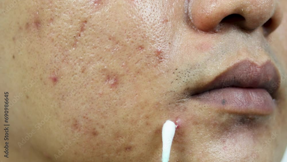 Vidéo Stock skin problems. Close up of Inflamed acne problem on Asian ...