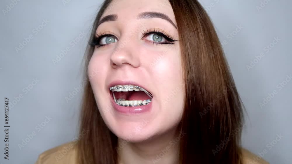 Young lady in braces opens mouth wide, shows tension of corrective ...