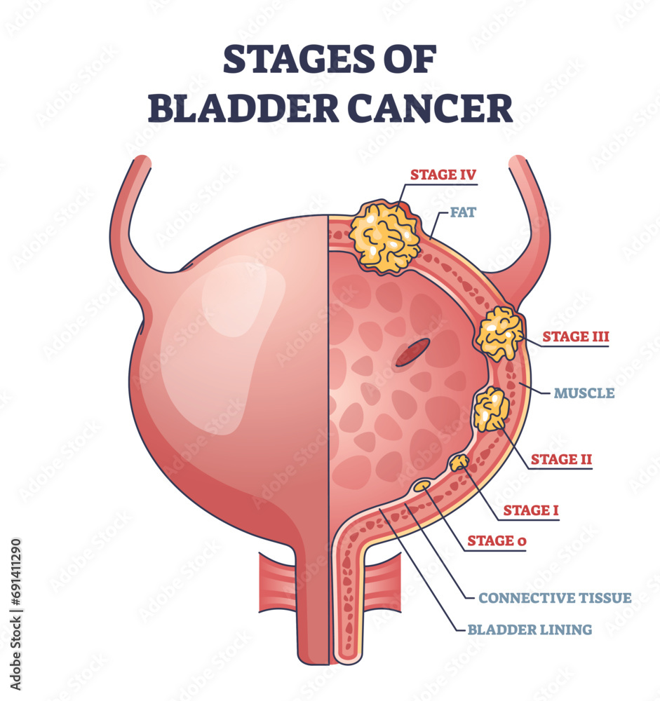 Stages of bladder cancer with anatomical oncology model outline diagram ...