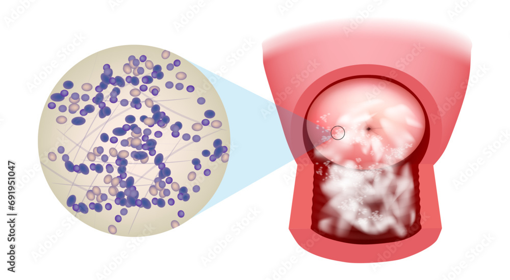 Vetor de Illustration of a candidiasis infection on the cervix. Candida ...