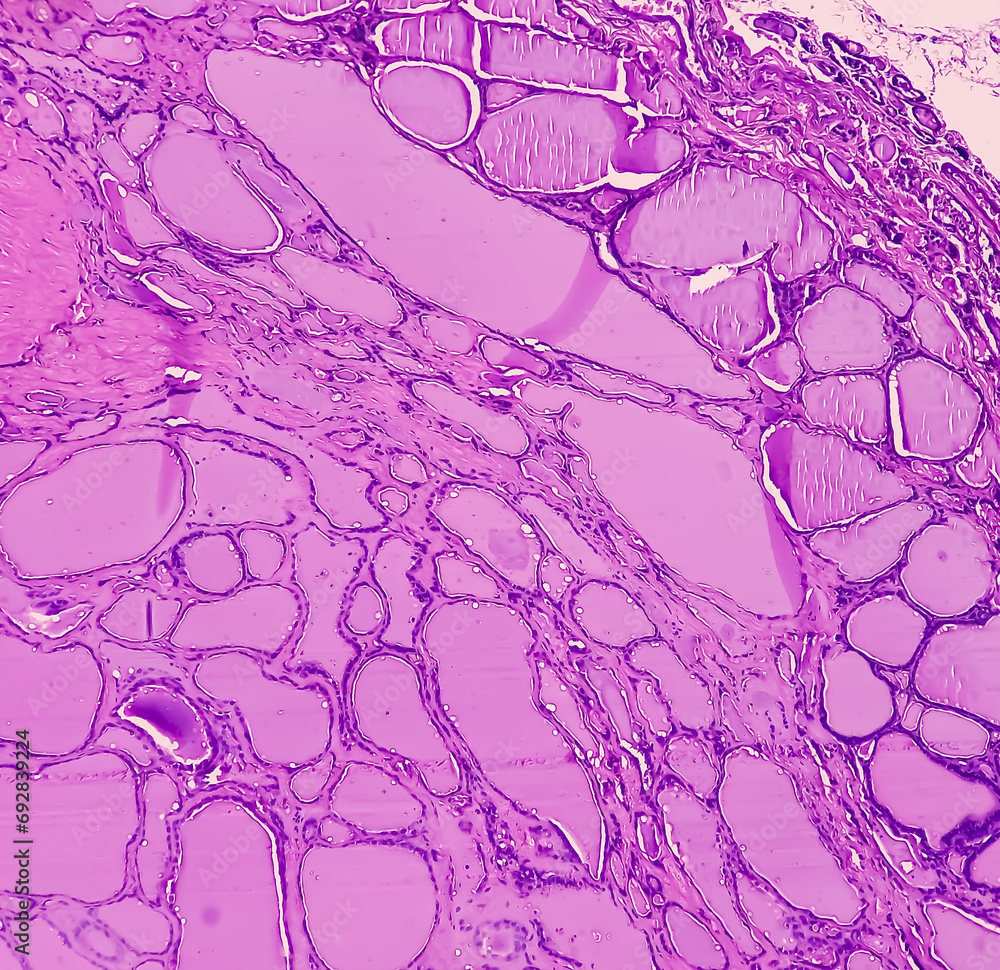 Thyroid Cancer Tracheal Gland Involved By Tumor Microscopic Image Of