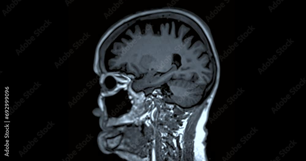 MRI Brain sagittal view can help doctors look for conditions such as ...