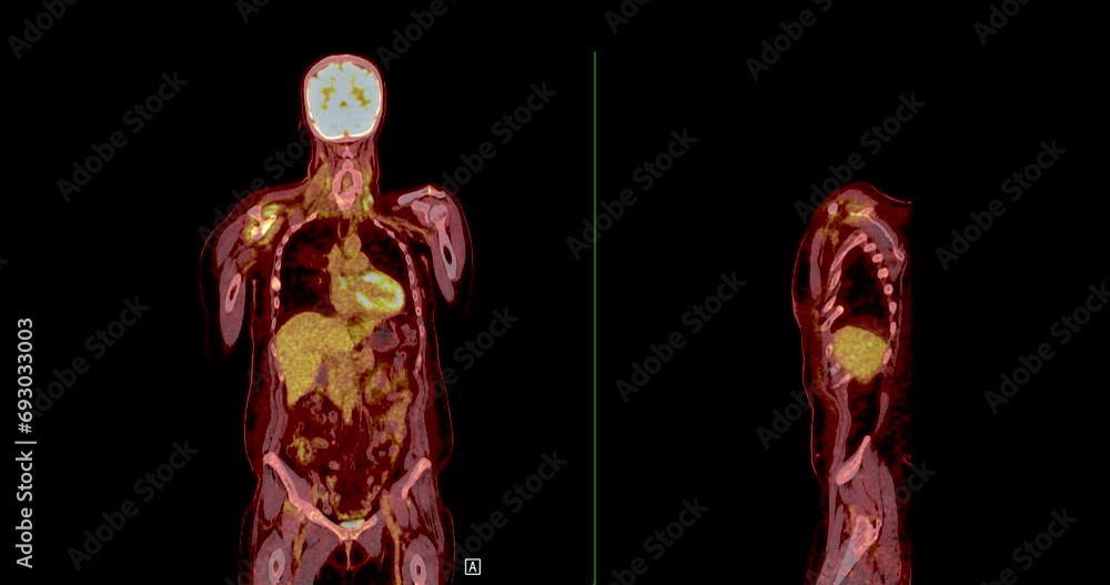 Vidéo Stock A PET-CT scan is a diagnostic imaging technique combining ...