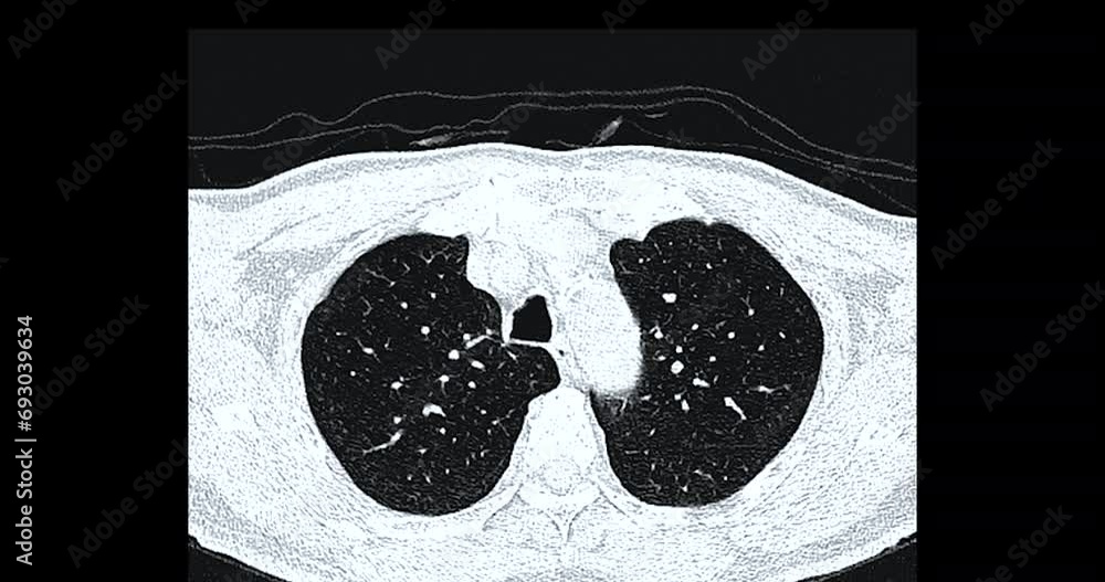 CT Chest or CT Scan of Lung axial MIP View for diagnosis TB,tuberculosis and coronavirus or ...