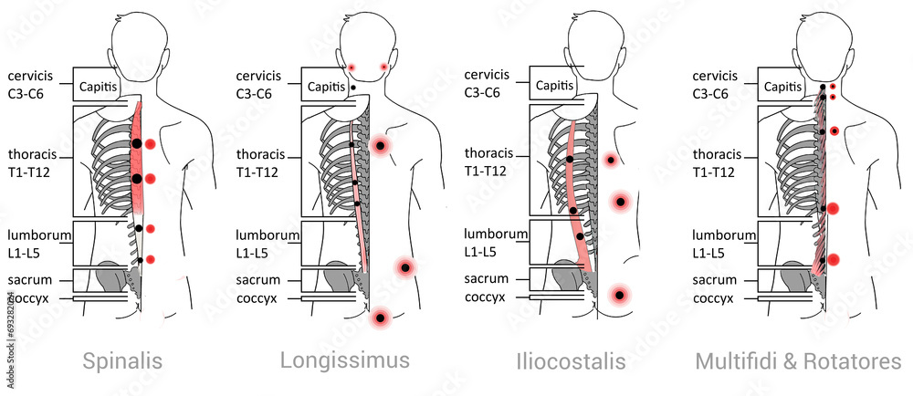 Myofascial Trigger Point, ilicostalis, longissimus, spinalis,deep ...