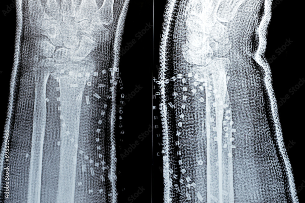 Colles fracture healing of an old female, a type of fracture of the ...