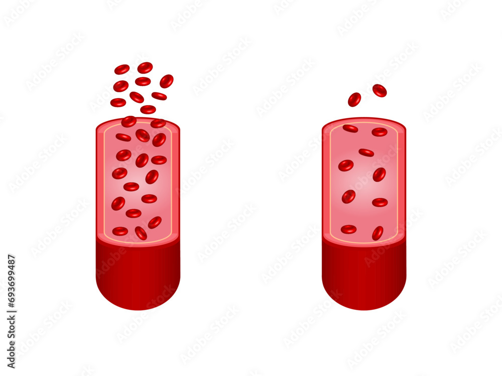 Iron deficiency anemia. The difference of Anemia amount of red blood ...