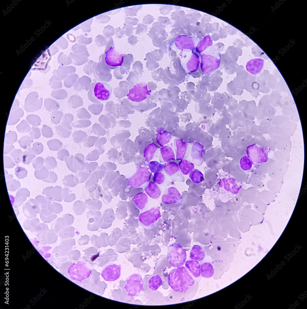 Leukemia. blood cells, blast cells and immature leukocytic cells in ...