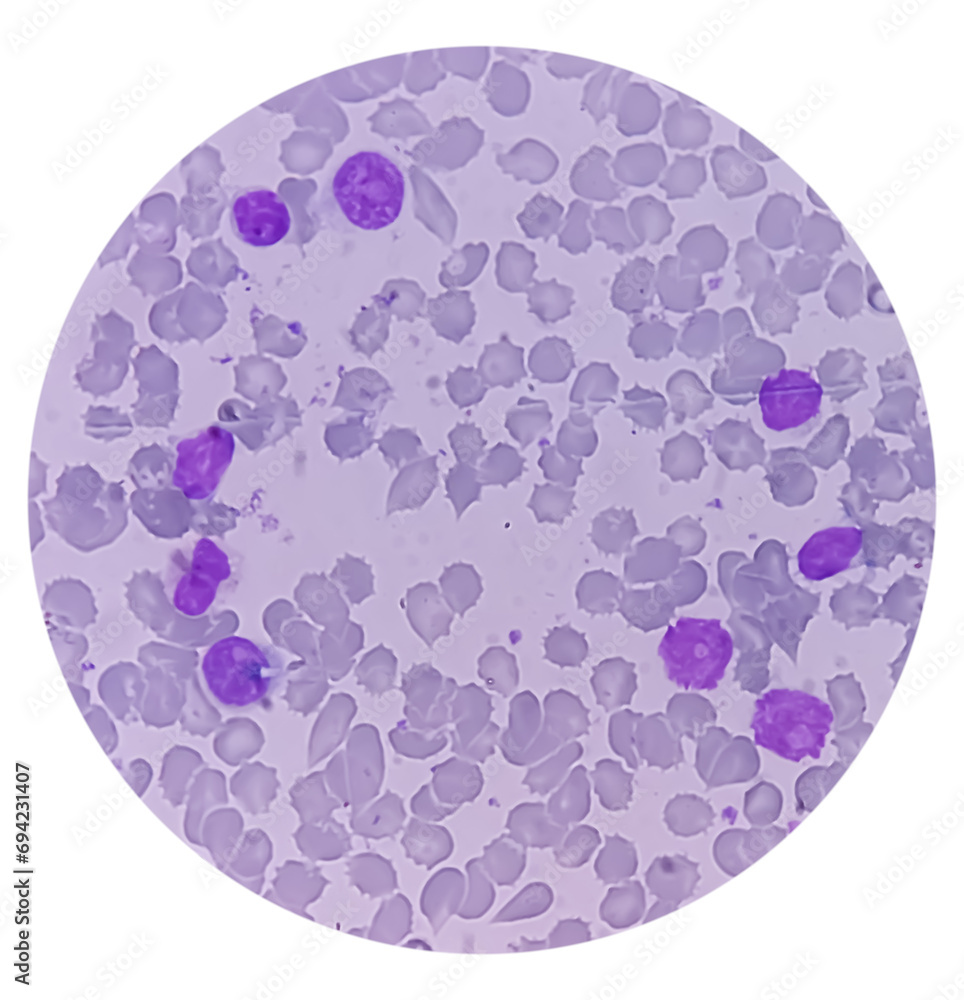 Leukemia. blood cells, blast cells and immature leukocytic cells in ...