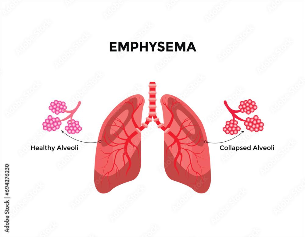 Emphysema disease concept. Damaged alveoli, failure airway. Floppy ...