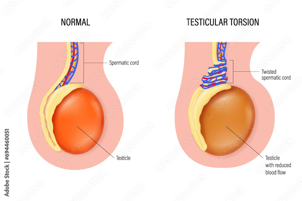 Testicular Torsion Vector Comparison Of Normal And Testicular Torsion