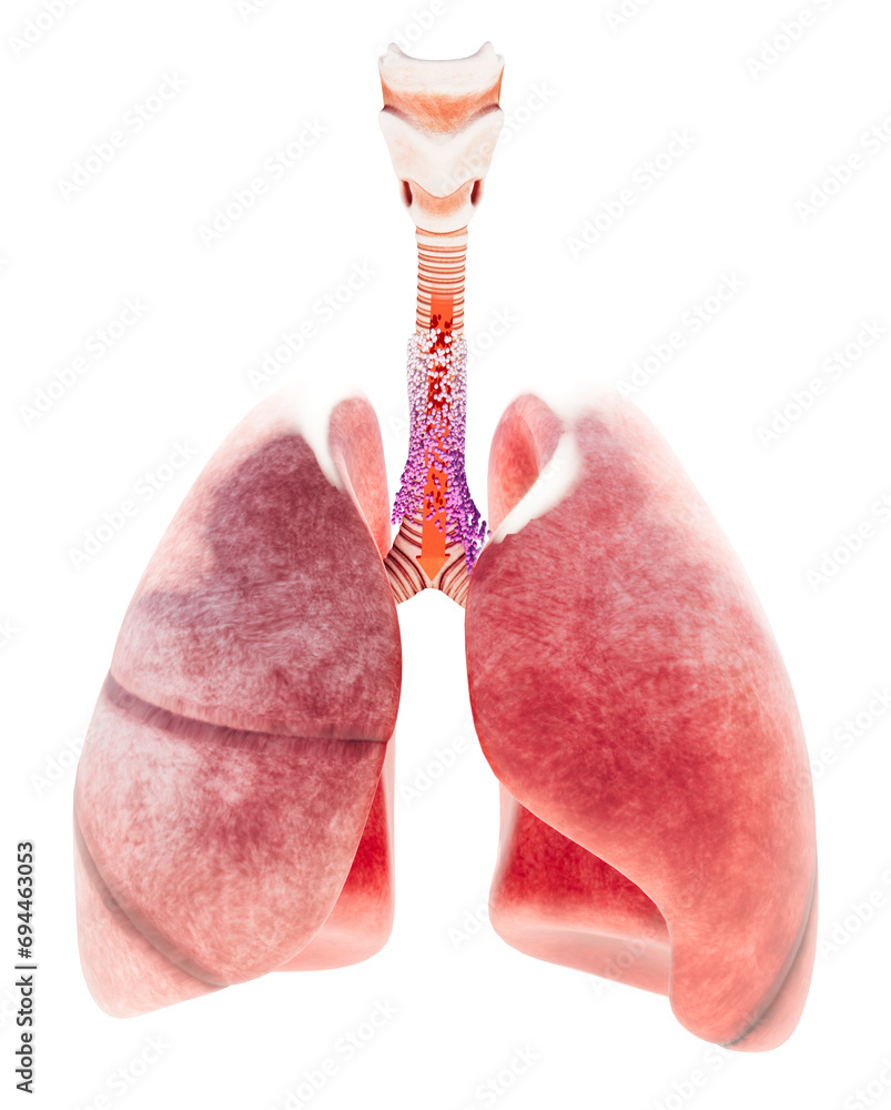 Trachea and bronchial tree, inflammation causing bronchitis. Acute or ...