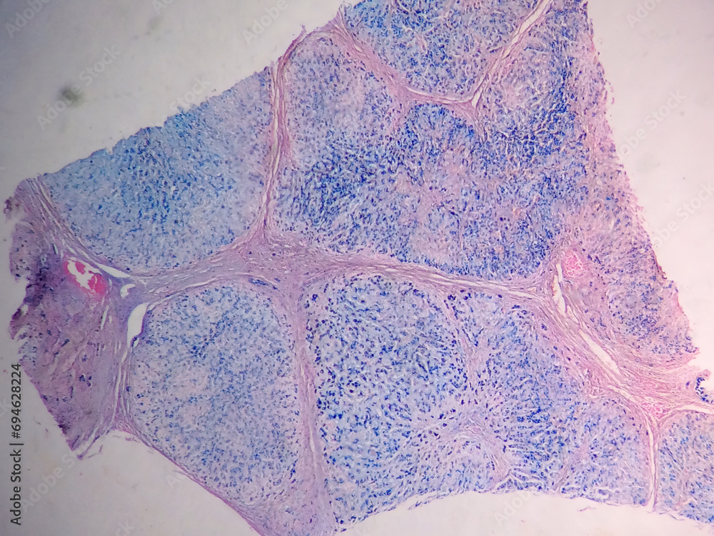 Liver with hemosiderin pigment, Perls Stain 4x Stock Photo | Adobe Stock