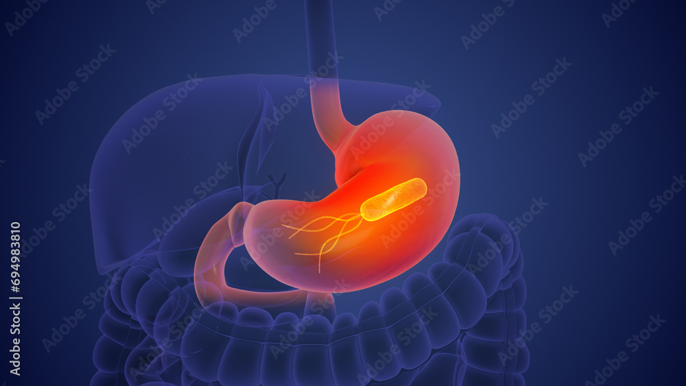 Stomach cancer is caused by the Helicobacter pylori bacterium. Stock ...