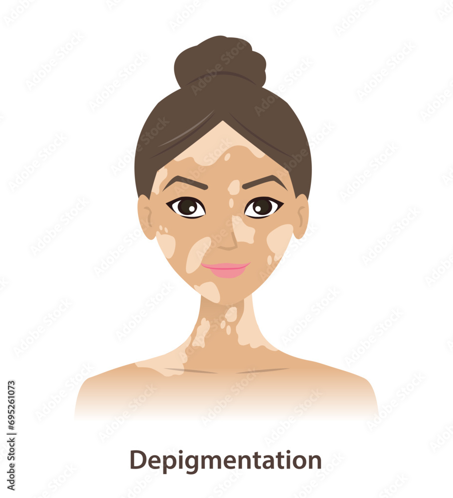 Depigmentation and white patches on woman face vector isolated on white ...