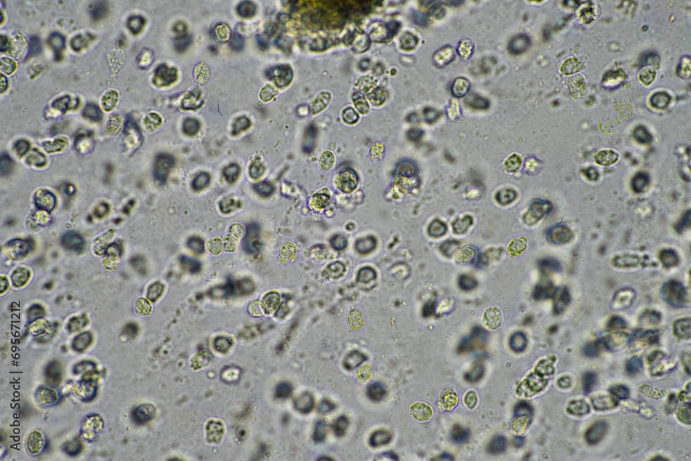 Plagát Coughing up mucus and phlegm from a chest infection from a virus ...