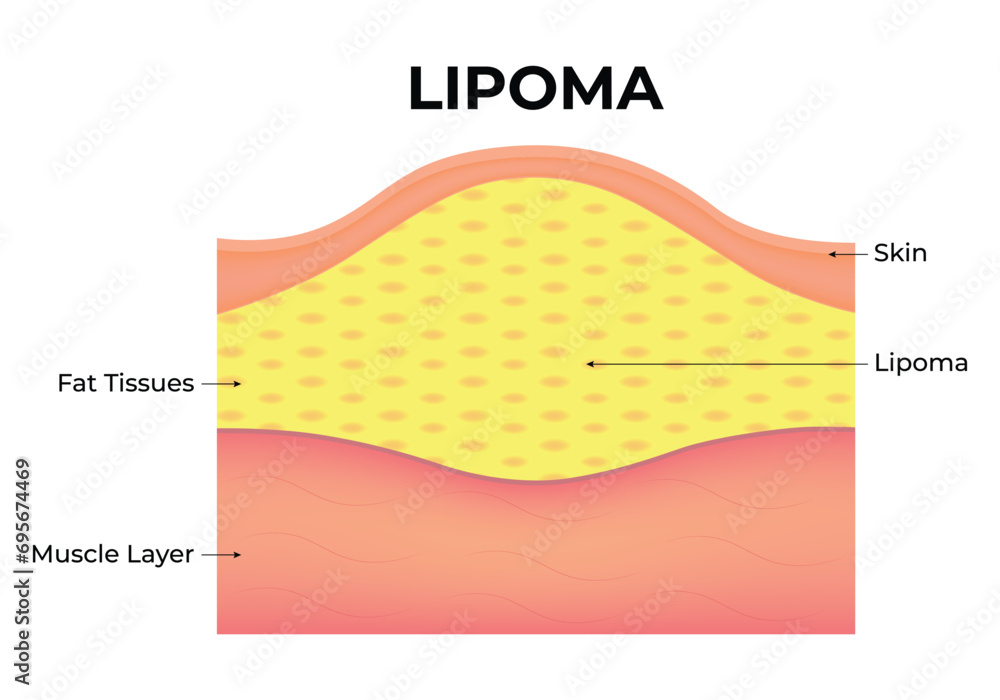 Lipoma Science Design Vector Illustration Diagram Stock Vector | Adobe ...