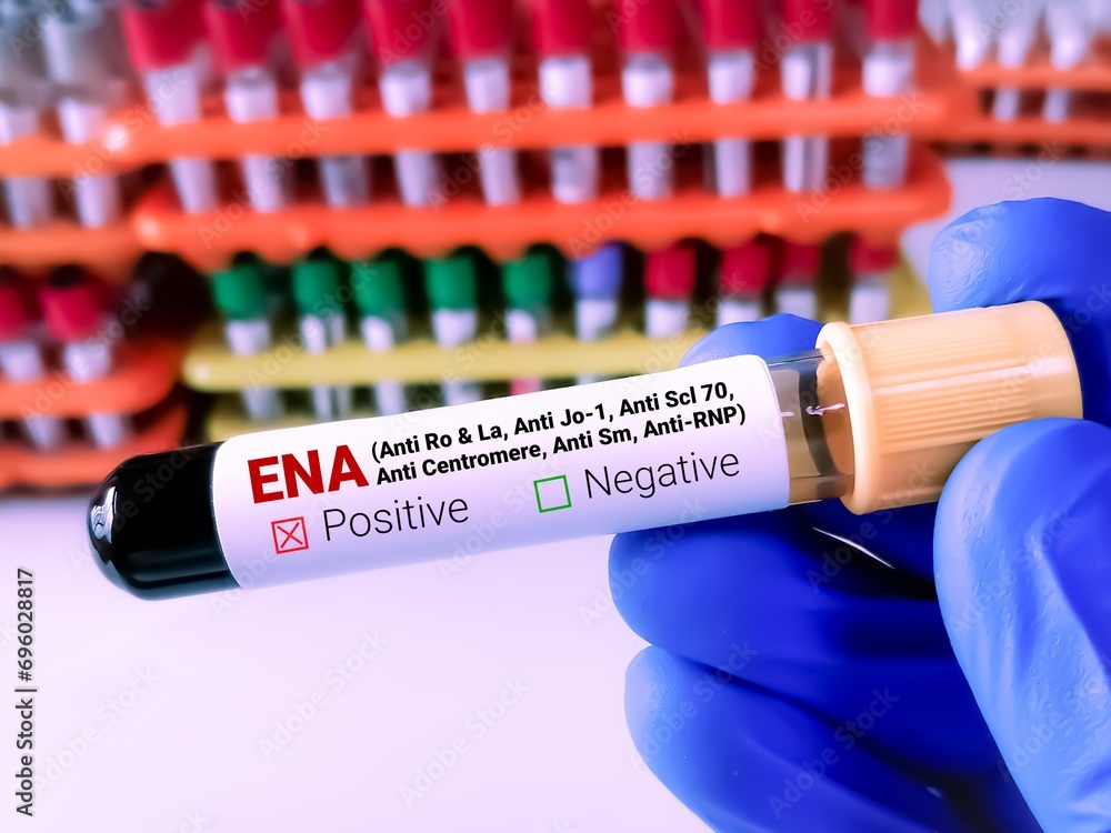 Blood sample and stethoscope isolated on ENA profile test report ...