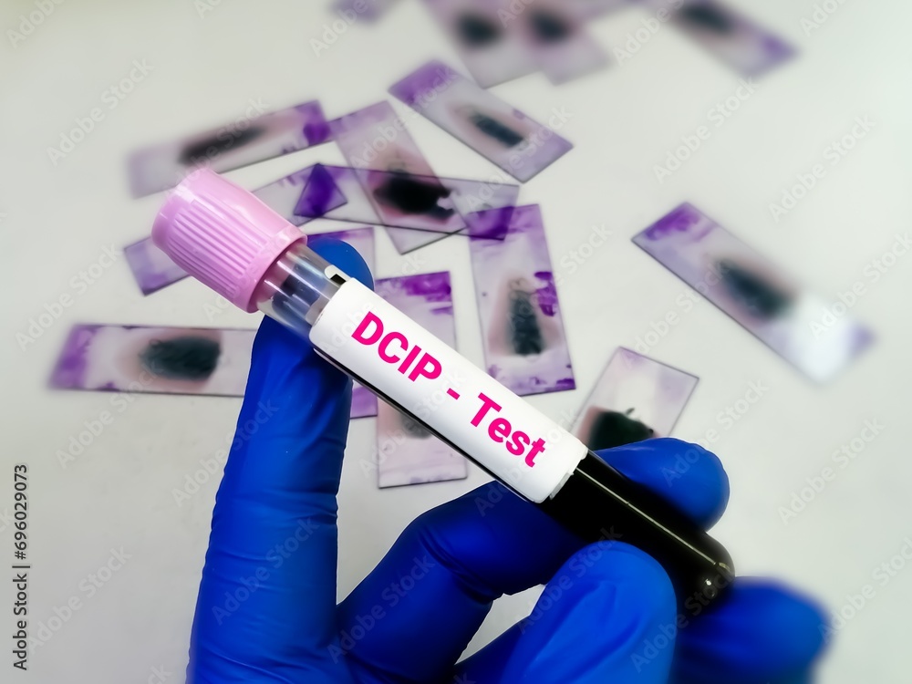 Blood sample tube for DCIP (dichlorophenol indophenol precipitation ...