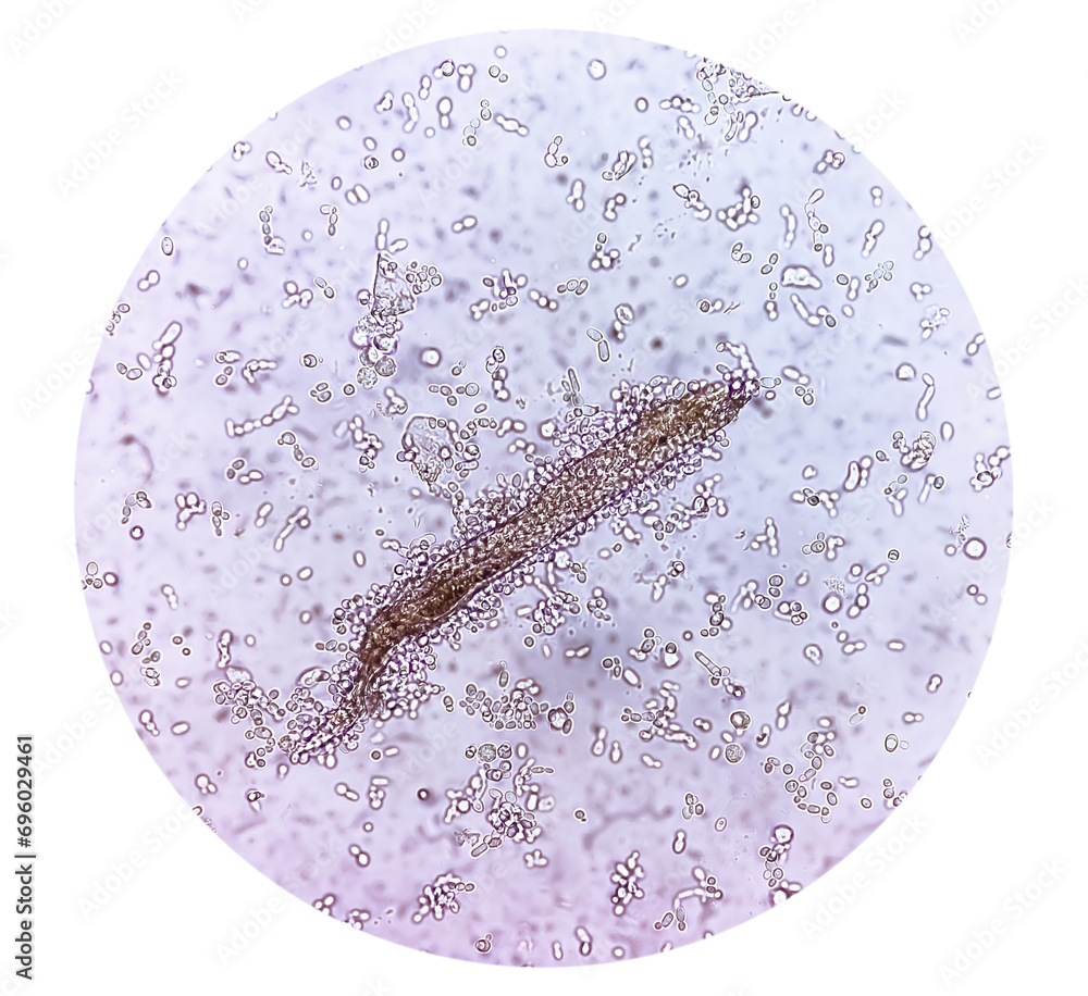 Microscopic urine examination showing Granular cast, Yeast and pus ...