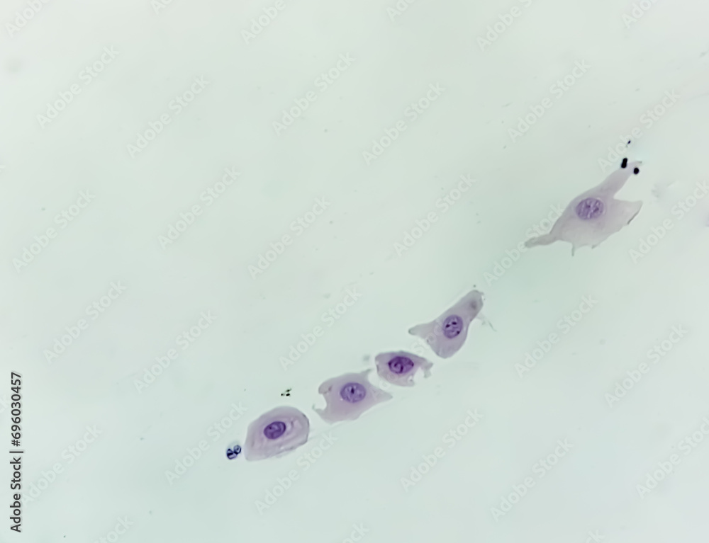 Photomicrograph of Paps smear: Inflammatory smear with HPV related ...