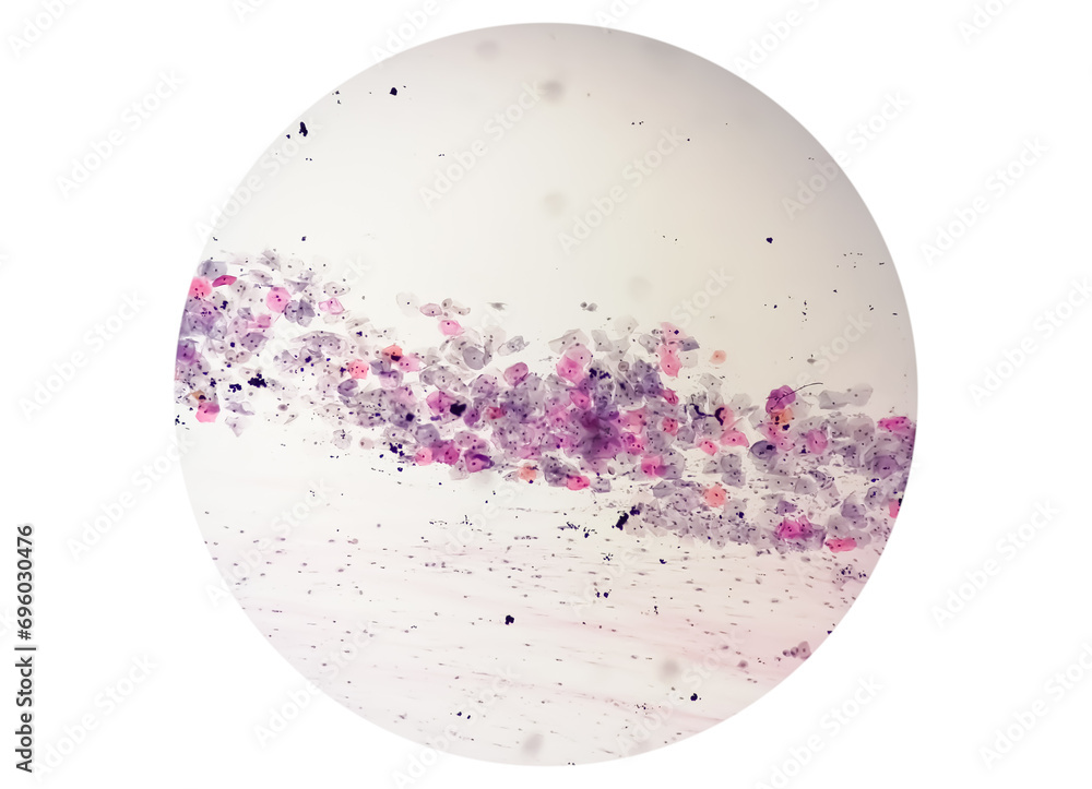 Photomicrograph of Paps smear: Inflammatory smear with HPV related ...
