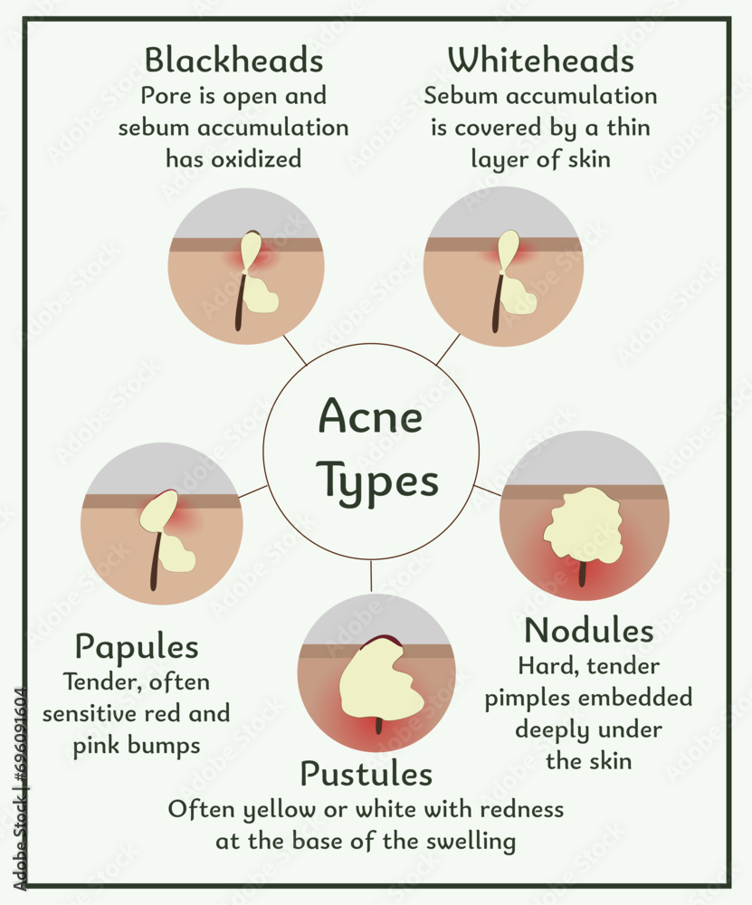 Acne types. Medical illustration. Infographic about skin and ...