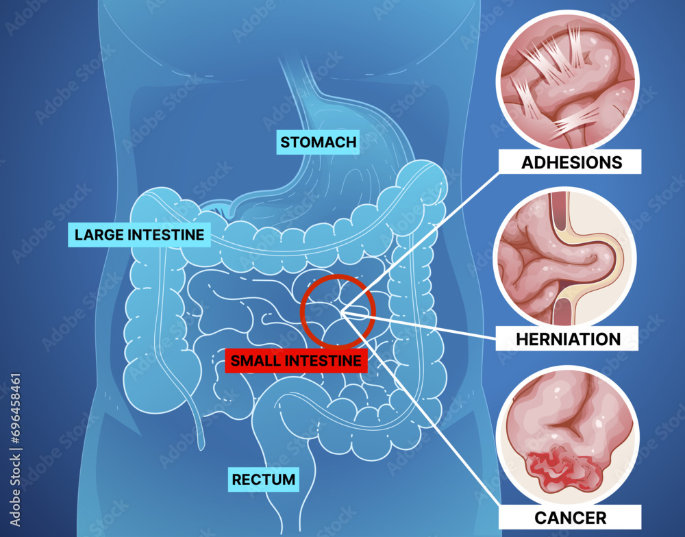 Bowel obstruction. Infographic. Healthcare illustration. Vector ...
