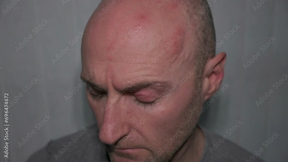 Vidéo Stock 50fps. Man with painful shingles virus. Lumps and blisters ...