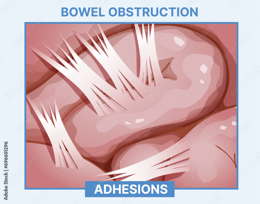 Bowel obstruction. Adhesions. Fibrous bands that form between tissues and organs. Infographic ...