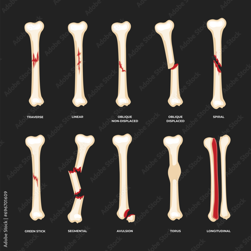Poster Set of different types of bone fracture collection, Diagram of ...