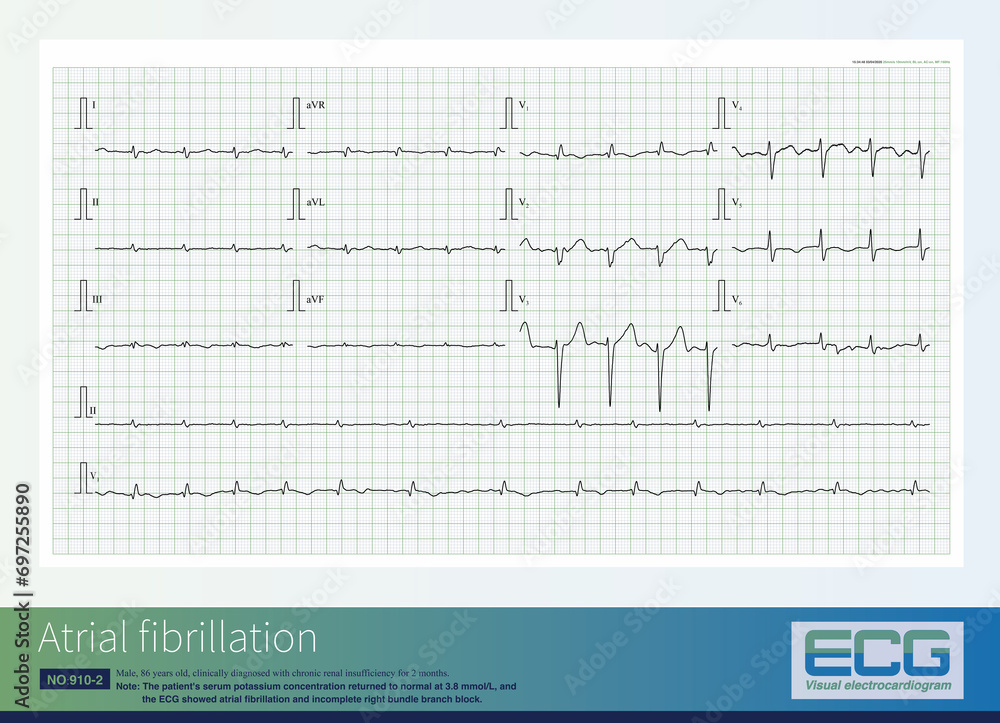 This was another ECG in patients with hyperkalemia after potassium ...