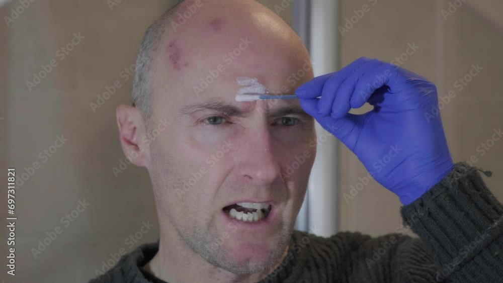 Man with painful shingles virus. Scabs and blisters on his face, head ...