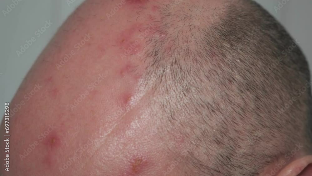 Man with painful shingles virus. Scabs and blisters on his face, head ...