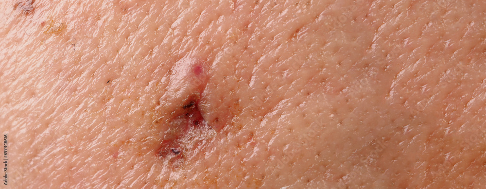 Scars from facial abscess or big acne surgery. Scars from inflammation ...