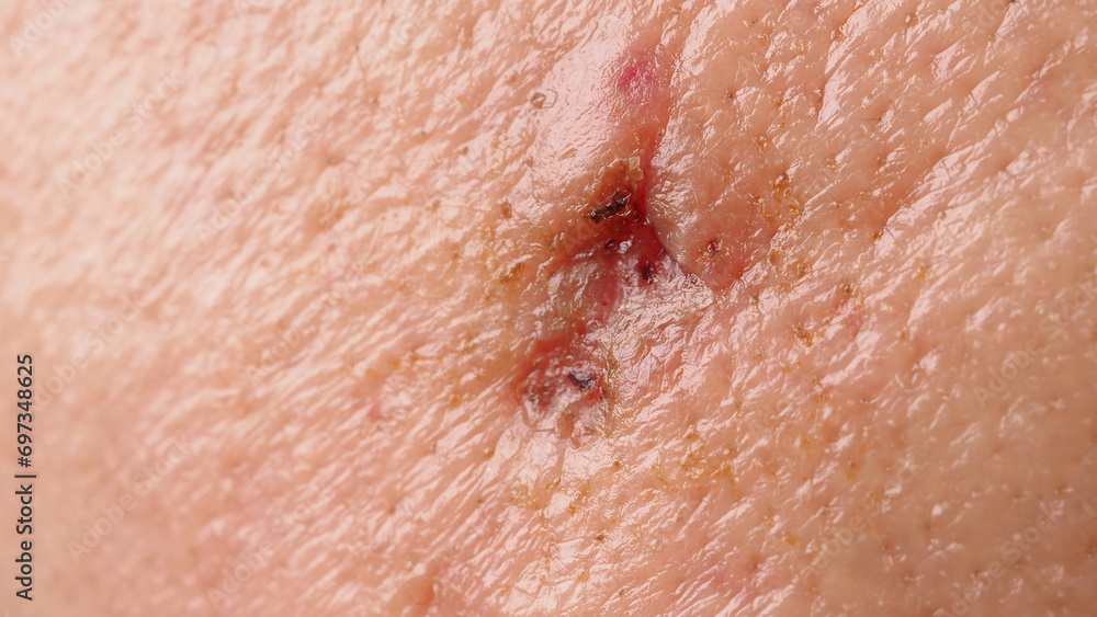 Scars from facial abscess or big acne surgery. Scars from inflammation ...