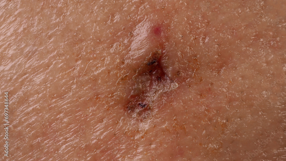 Scars from facial abscess or big acne surgery. Scars from inflammation ...