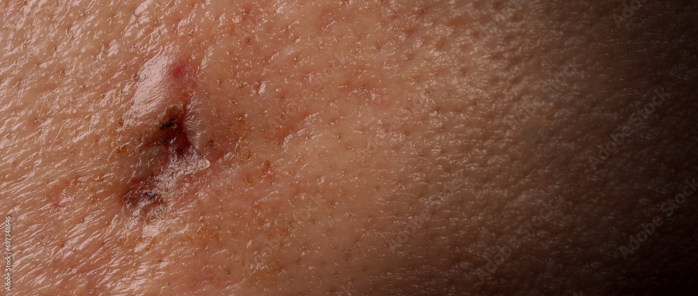 Scars from facial abscess or big acne surgery. Scars from inflammation ...