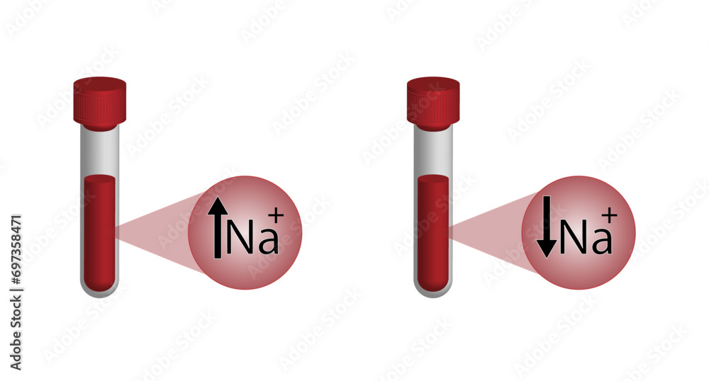 Hypernatremia, high plasma sodium level and Hyponatremia, low plasma ...