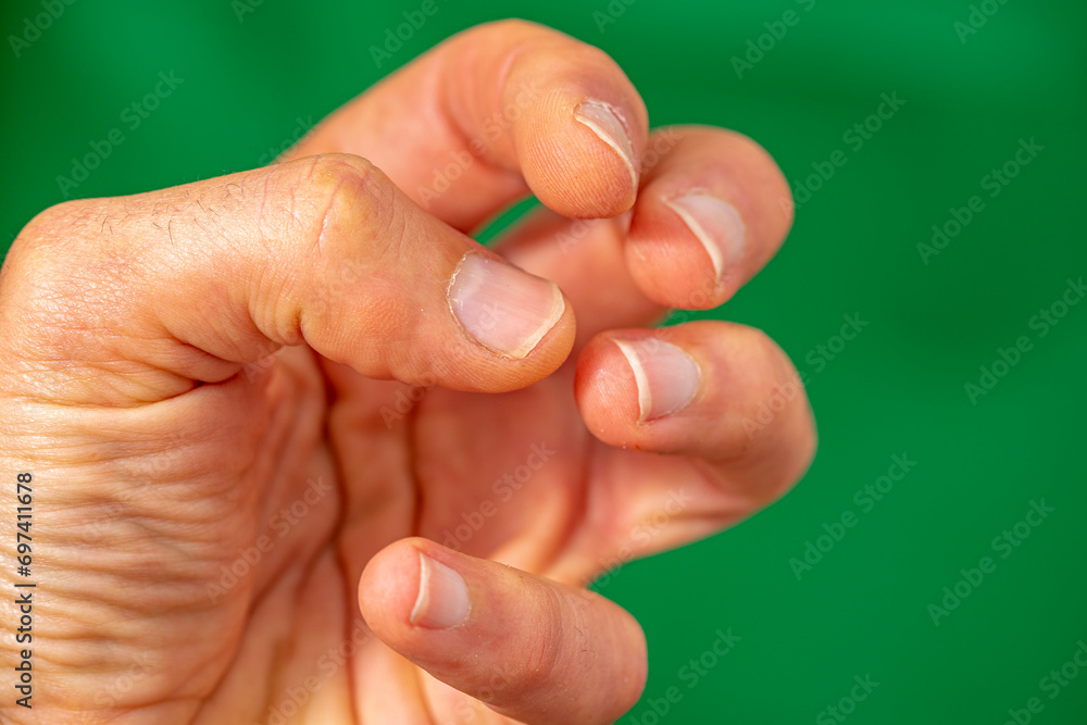 5 human fingers together of the hand with bitten nails under green ...