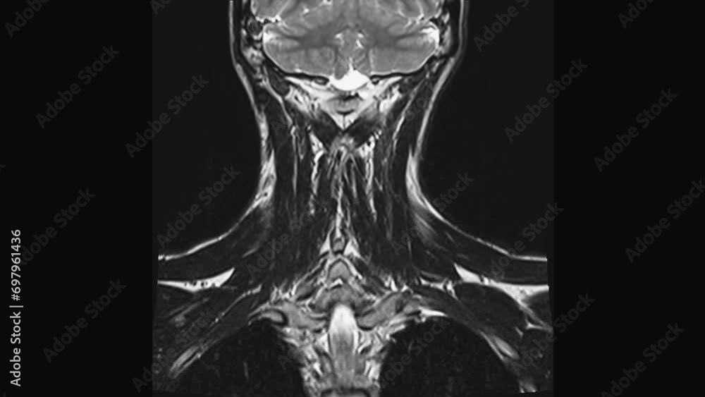 MRI scans of the cervical spine human body. Examining and identifying ...