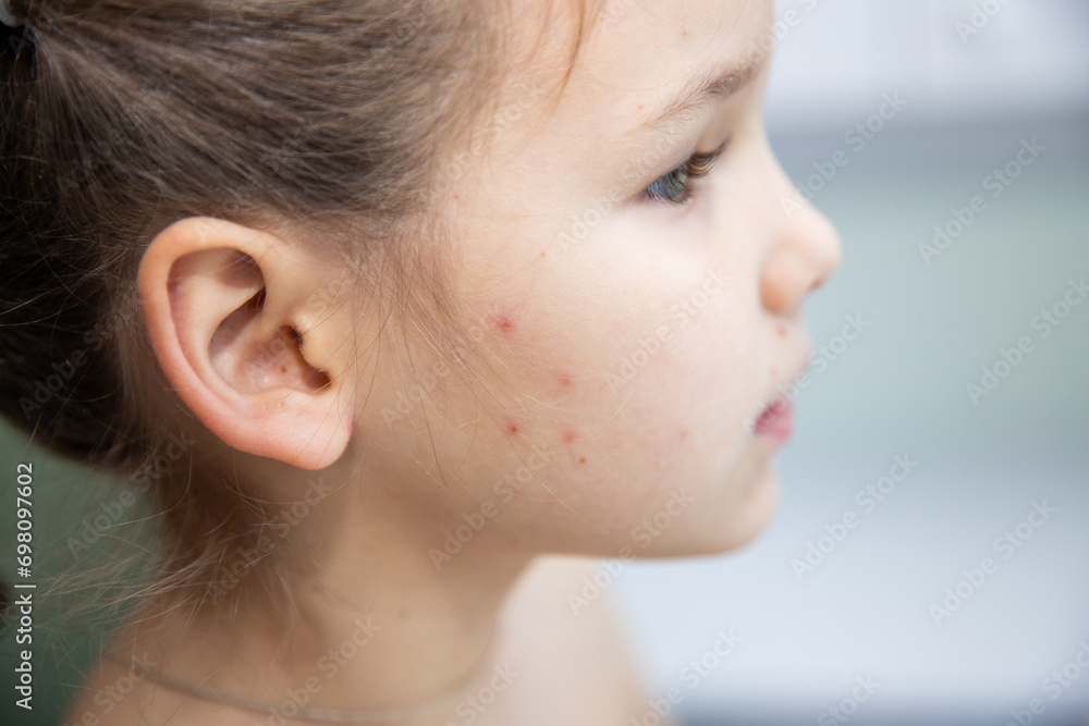 Portrait of a girl in profile with a rash on her cheek from chickenpox ...
