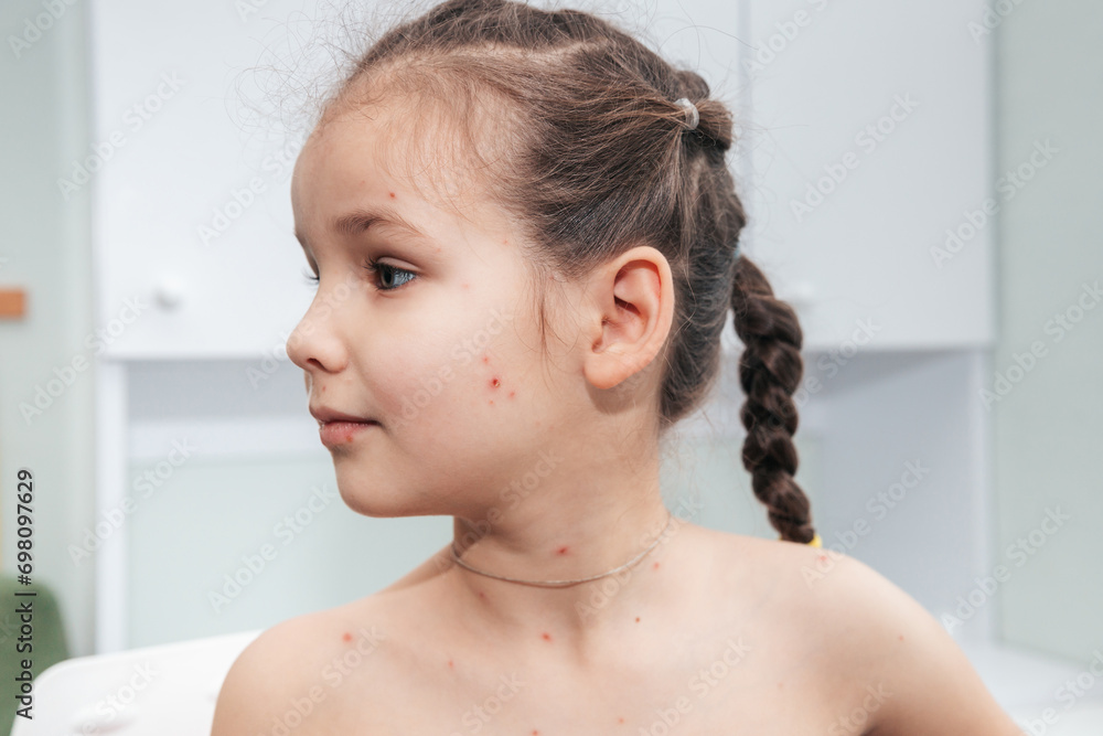 Portrait of a girl in profile with a rash on her cheek from chickenpox ...