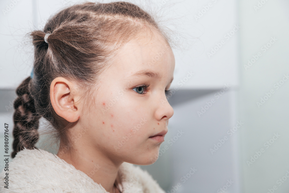 Portrait of a girl in profile with a rash on her cheek from chickenpox ...