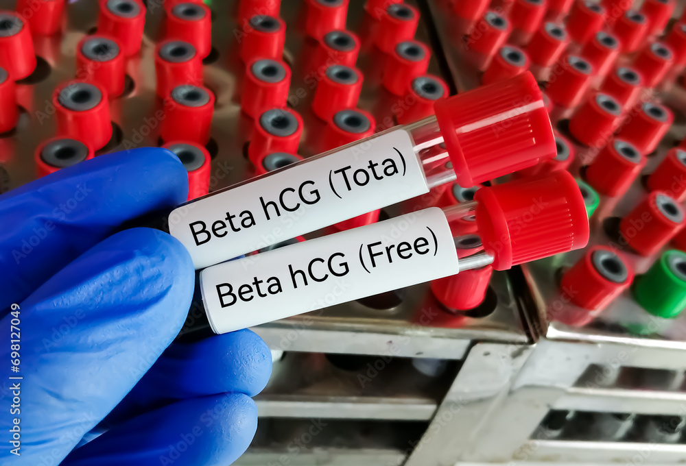Blood samples in doctor hand for Beta hCG (total and free) test Stock ...
