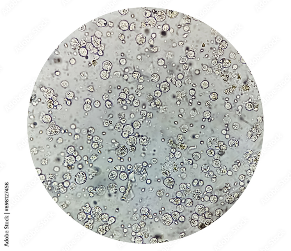 Photomicrograph of urinalysis showing plenty pus cells, urinary tract ...