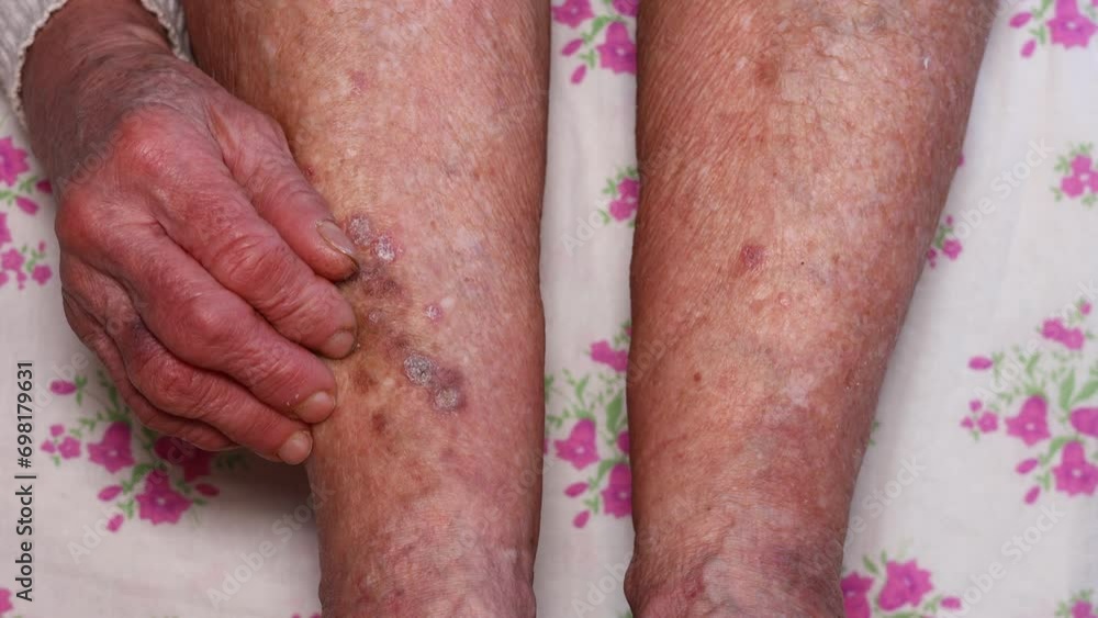 Skin diseases of elderly people, Old woman rubs and scratches pimples ...